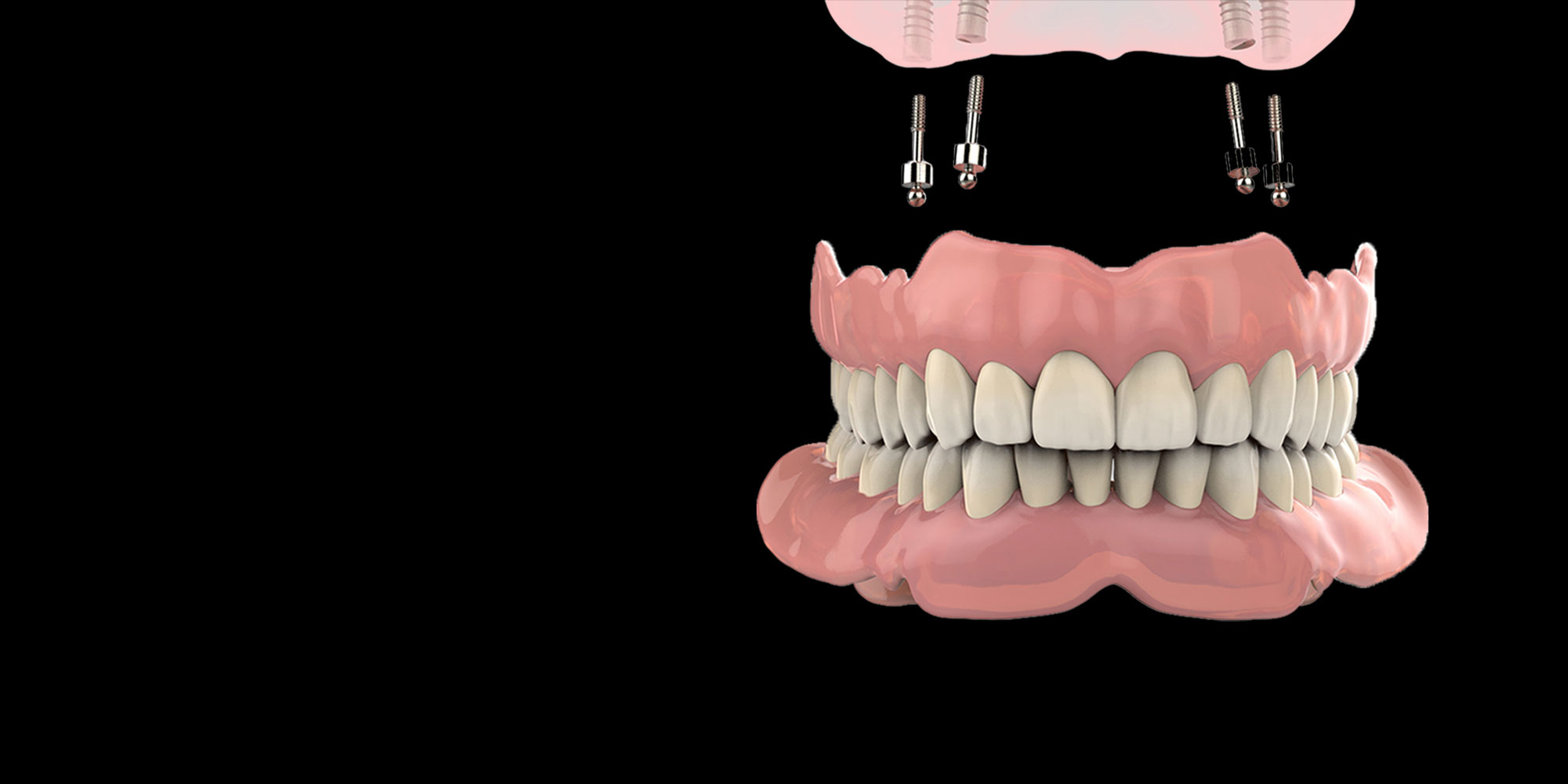 Hybrid Fixed Detachable Dentures | West LA Implants